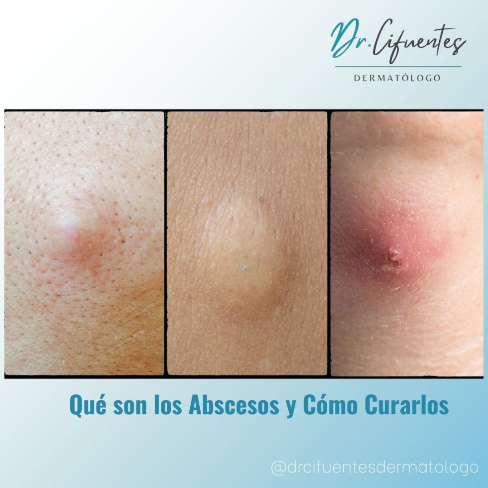 Qué son los Abscesos y Cómo Curarlos - Doctor Cifuentes Dermatologo